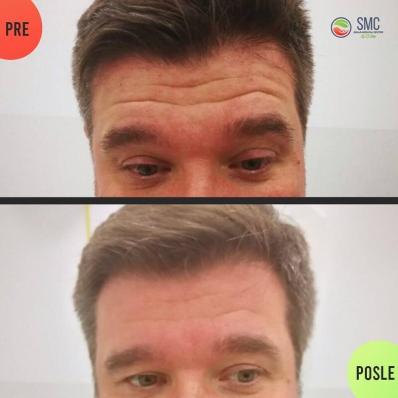 Botoks Beograd | Botulinski toksin | Solar Medical Center